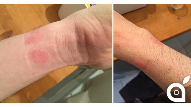 Apple Watch Causes Skin Irritation, Allergic Reactions for Some Users ...